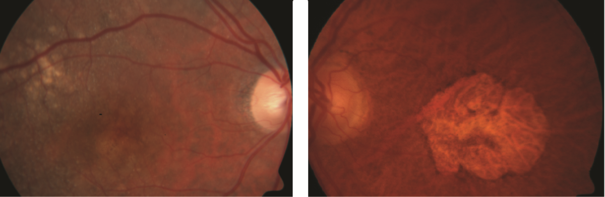 Figure 1. Dry AMD. A. Drusen (indicated by arrow). B. Geographic ...