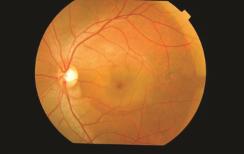 Central Serous Chorioretinopathy | Retina Specialists of North Alabama, LLC