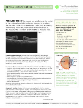 fact_sheet_macular_hole | Retina Specialists of North Alabama, LLC