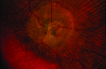 Figure 2. Macular scarring, retinal hemorrhages (bleeds), crystals and ...