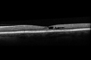 Figure 3. OCT shows intraretinal cleft in temporal macula typical of ...