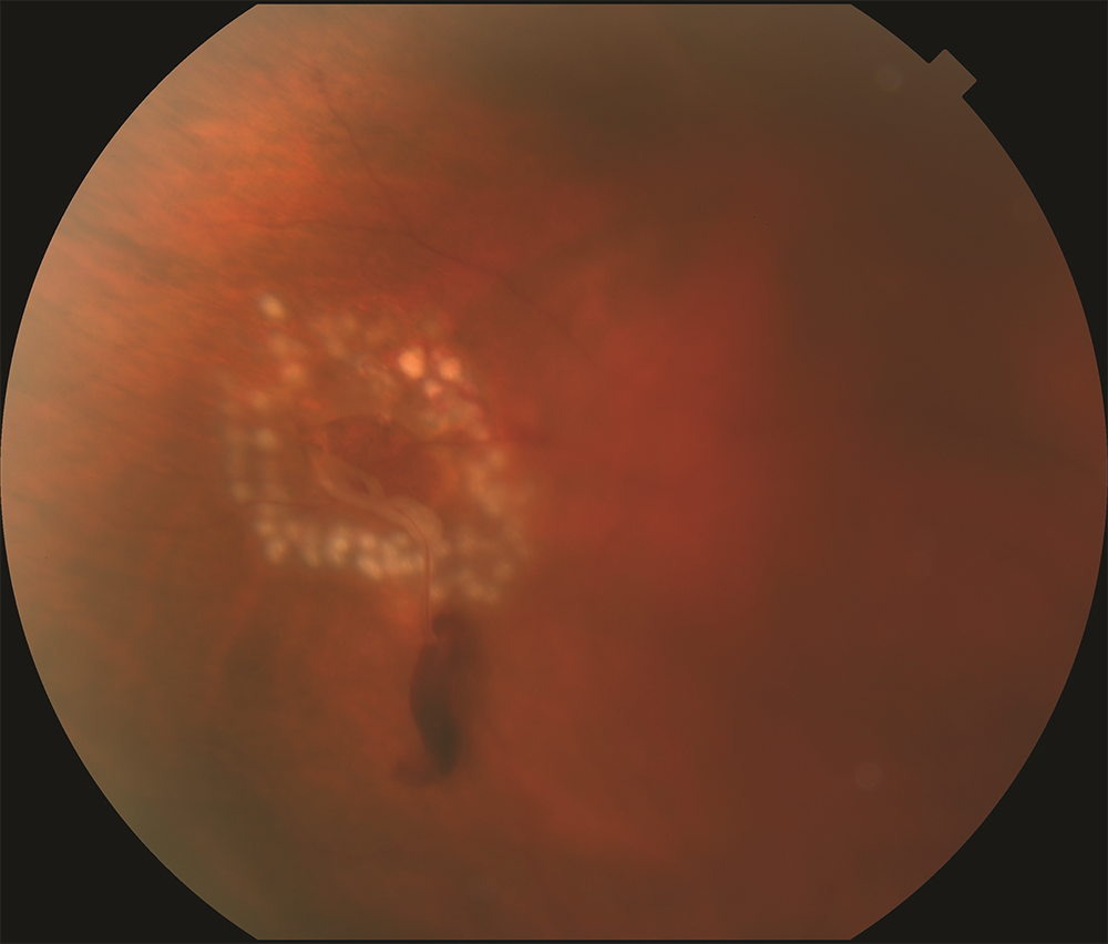 Retinal Tears Retina Specialists Of North Alabama LLC