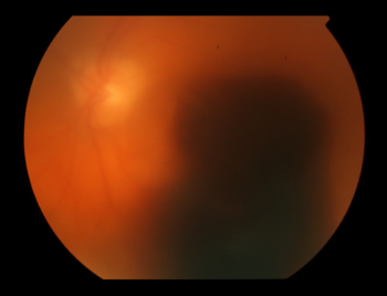 Figure 2. Vitreous hemorrhage, pre-retinal, and sub-retinal hemorrhages ...