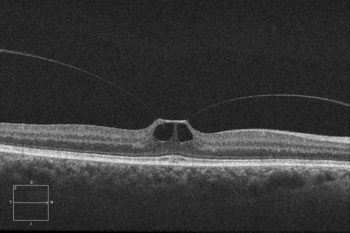 SD-OCT appearance of right eye showing vitreomacular traction | Retina ...