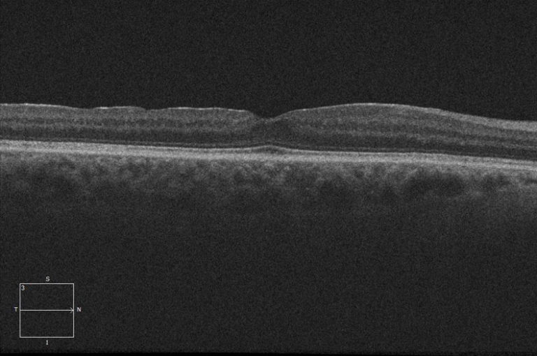Vitreomacular Traction Syndrome | Retina Specialists of North Alabama, LLC